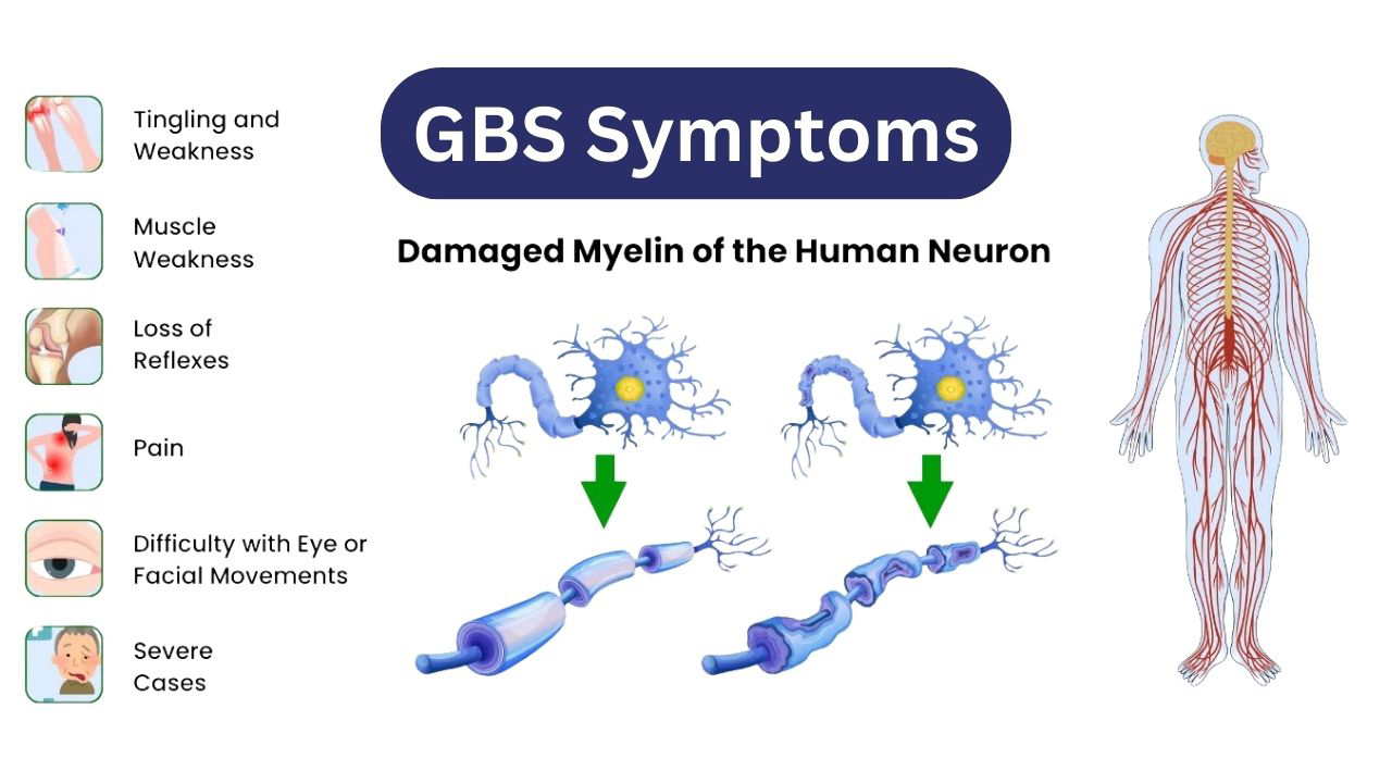Understanding Guillain-Barré Syndrome: Causes, Effects, and Treatment Options